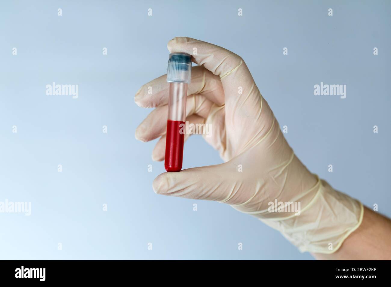 Test tube with a blood sample in the hands of a nurse. Blood test for ...