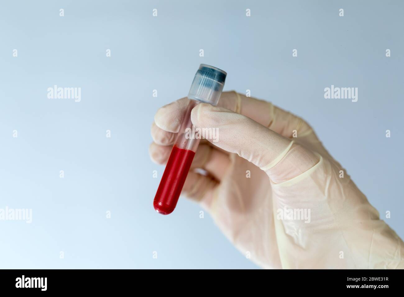 Test tube with a blood sample in the hands of a nurse. Blood test for ...