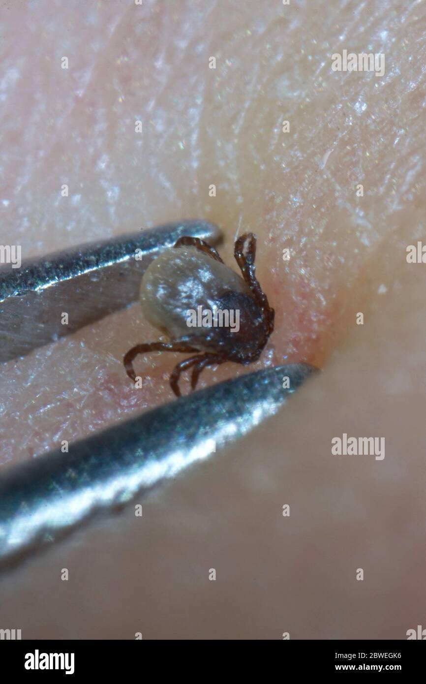 Tick Head Removal Human