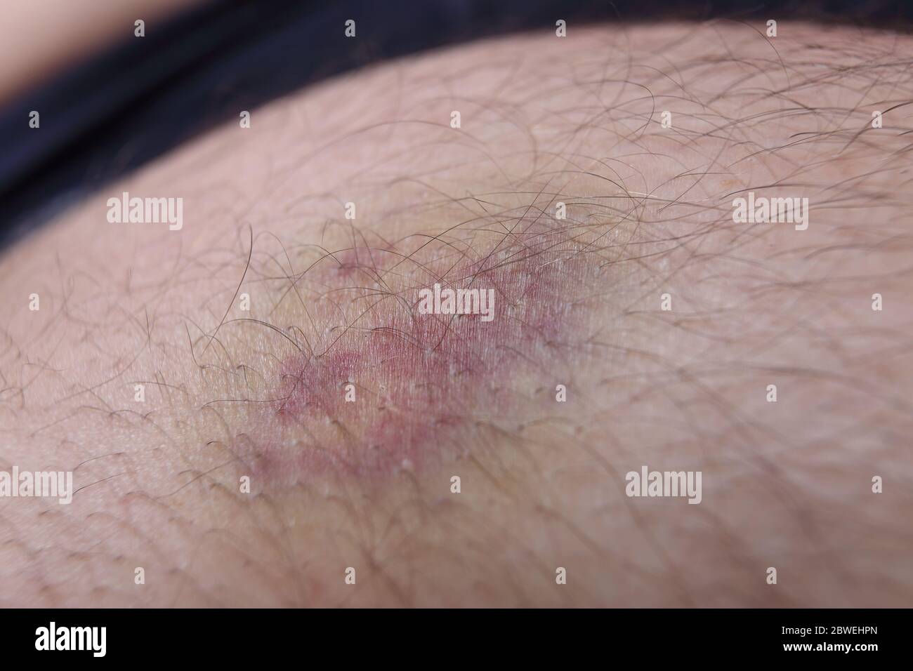 Bruise skin wound female hi-res stock photography and images - Alamy