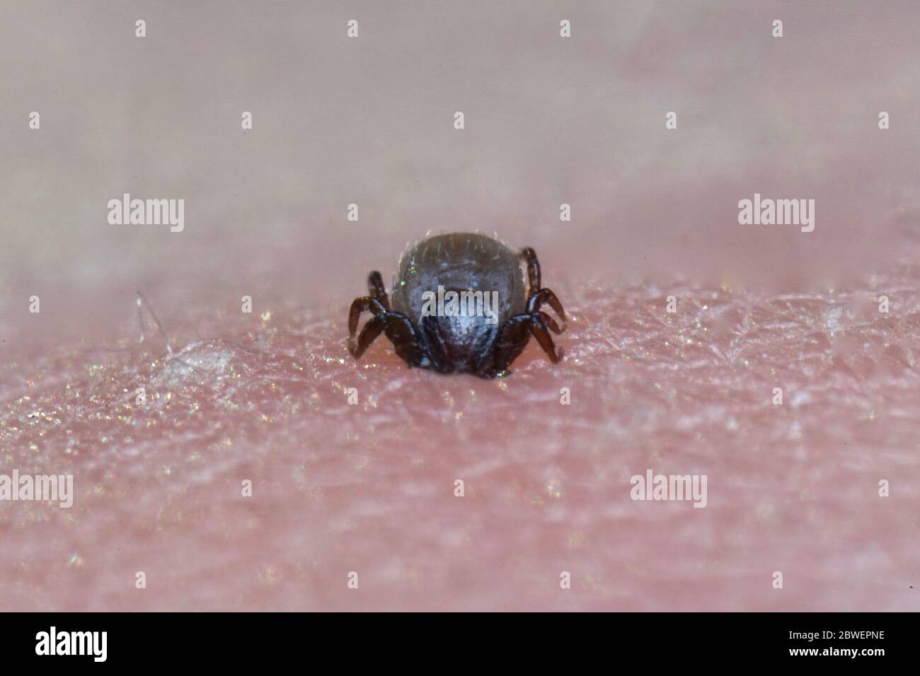 Super close up of sucking Ixodes ricinus on human skin. Adults feed on ...