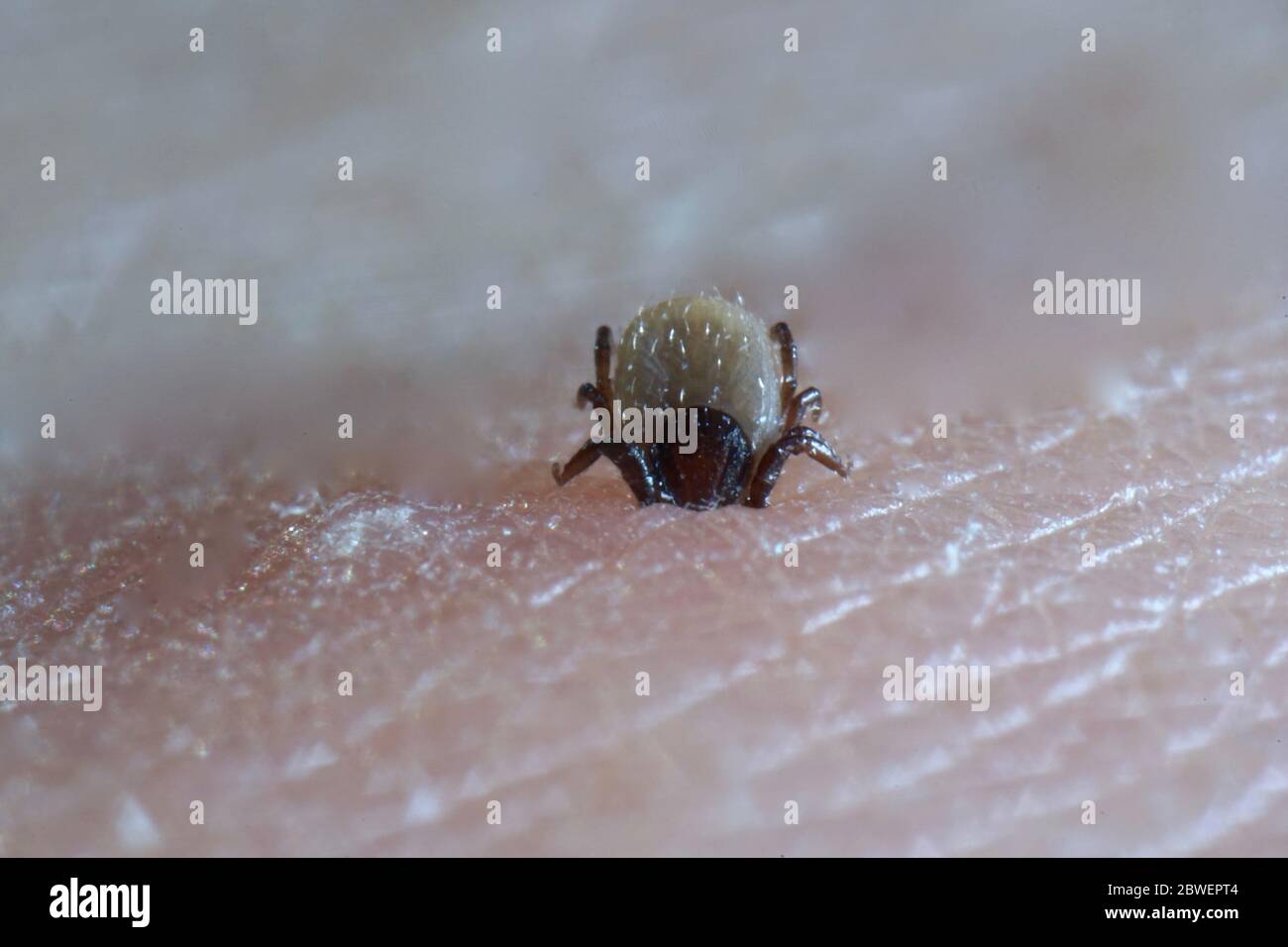 Super close up of sucking Ixodes ricinus on human skin. Adults feed on ...