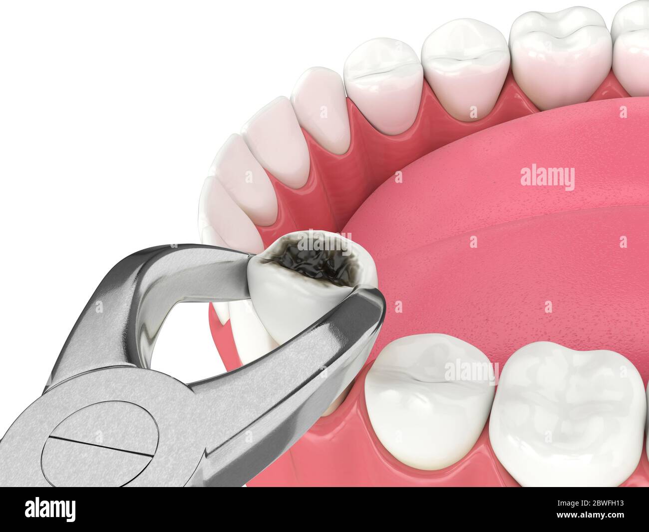 Gums disease loss teeth hi-res stock photography and images - Alamy