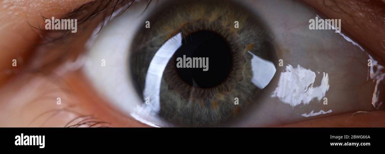 Cataract of right eye hi-res stock photography and images - Alamy