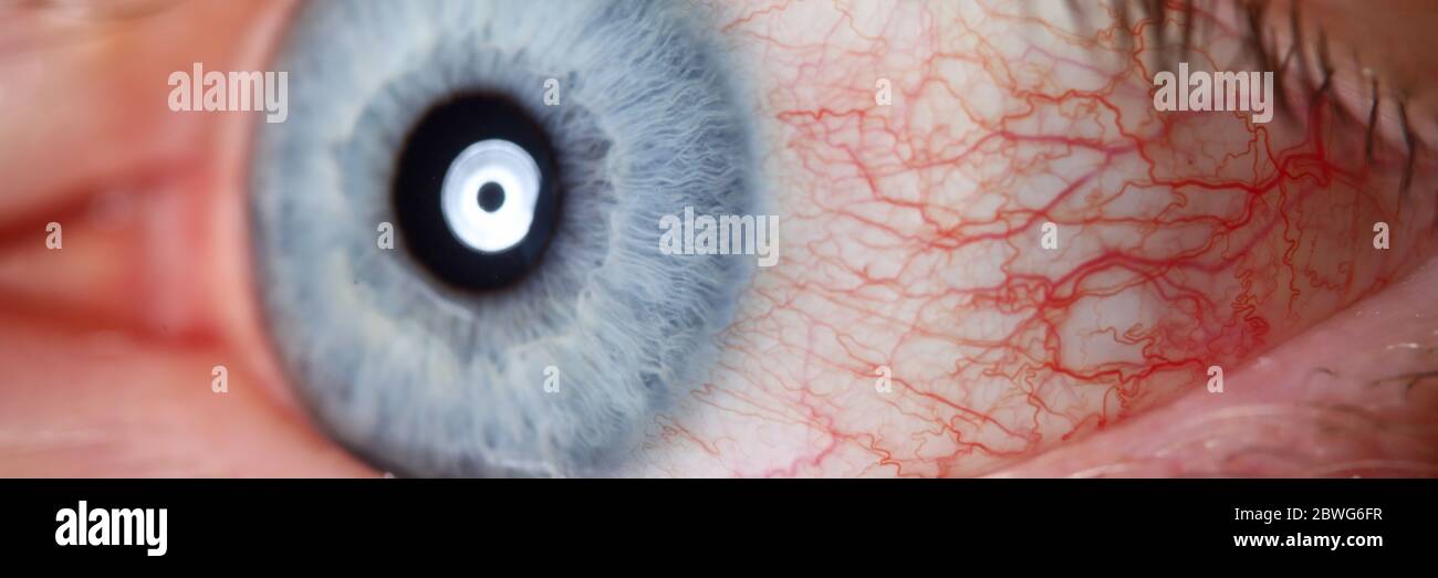 Irritated male blue eye full with capillar net Stock Photo - Alamy