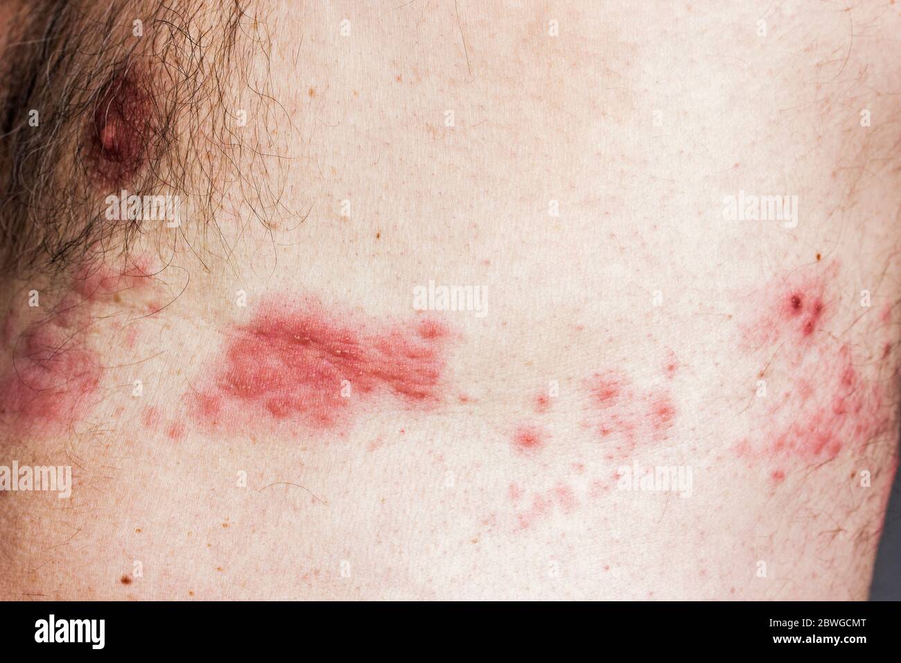 Skin rash of varicella-zoster virus also known as shingles on a senior ...