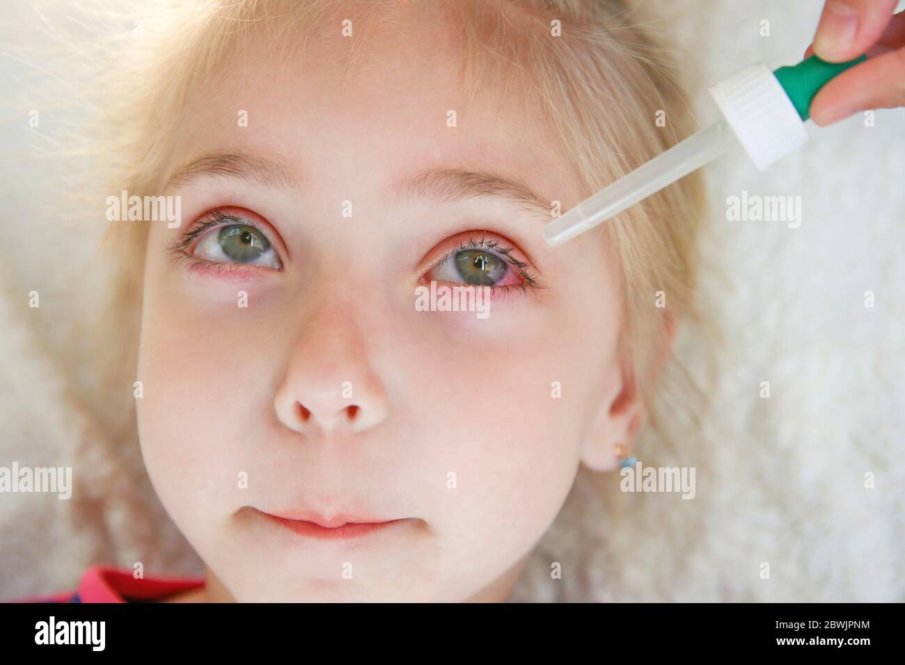 Pinkeye hi-res stock photography and images - Alamy