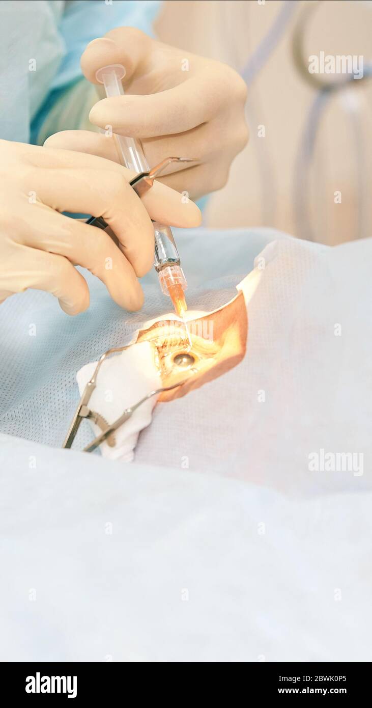Ophthalmology laser microscope operation. Doctor in clinic. Patient eye ...
