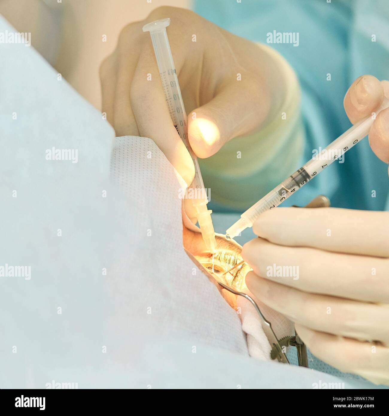 Ophthalmology laser microscope operation. Doctor in clinic. Patient eye ...