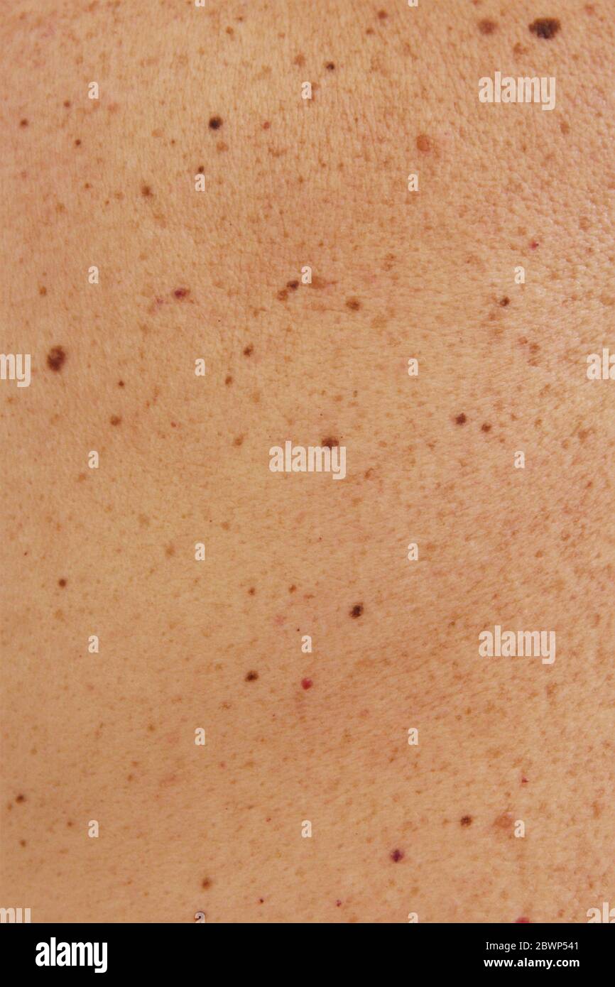 Birthmark and moles on skin texture background vertical photo Stock ...
