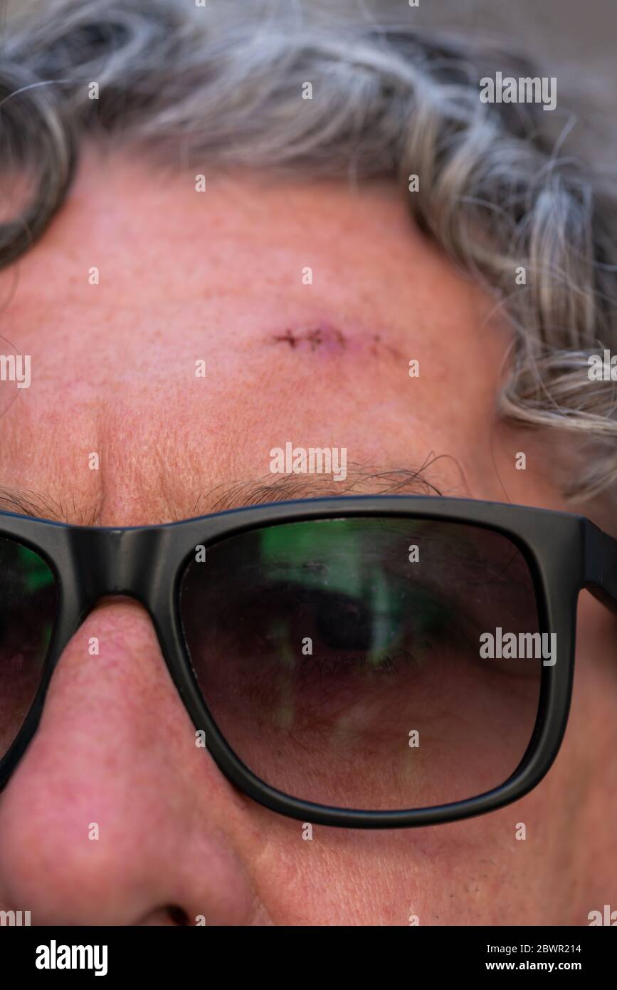With stitches on his forehead hi-res stock photography and images - Alamy
