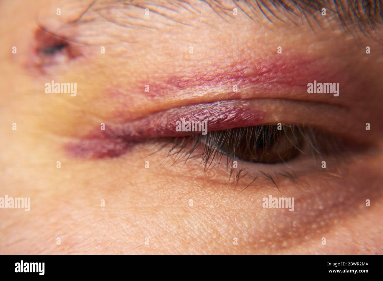 close view of a bruise near the eye, the face of a man with a hematoma ...