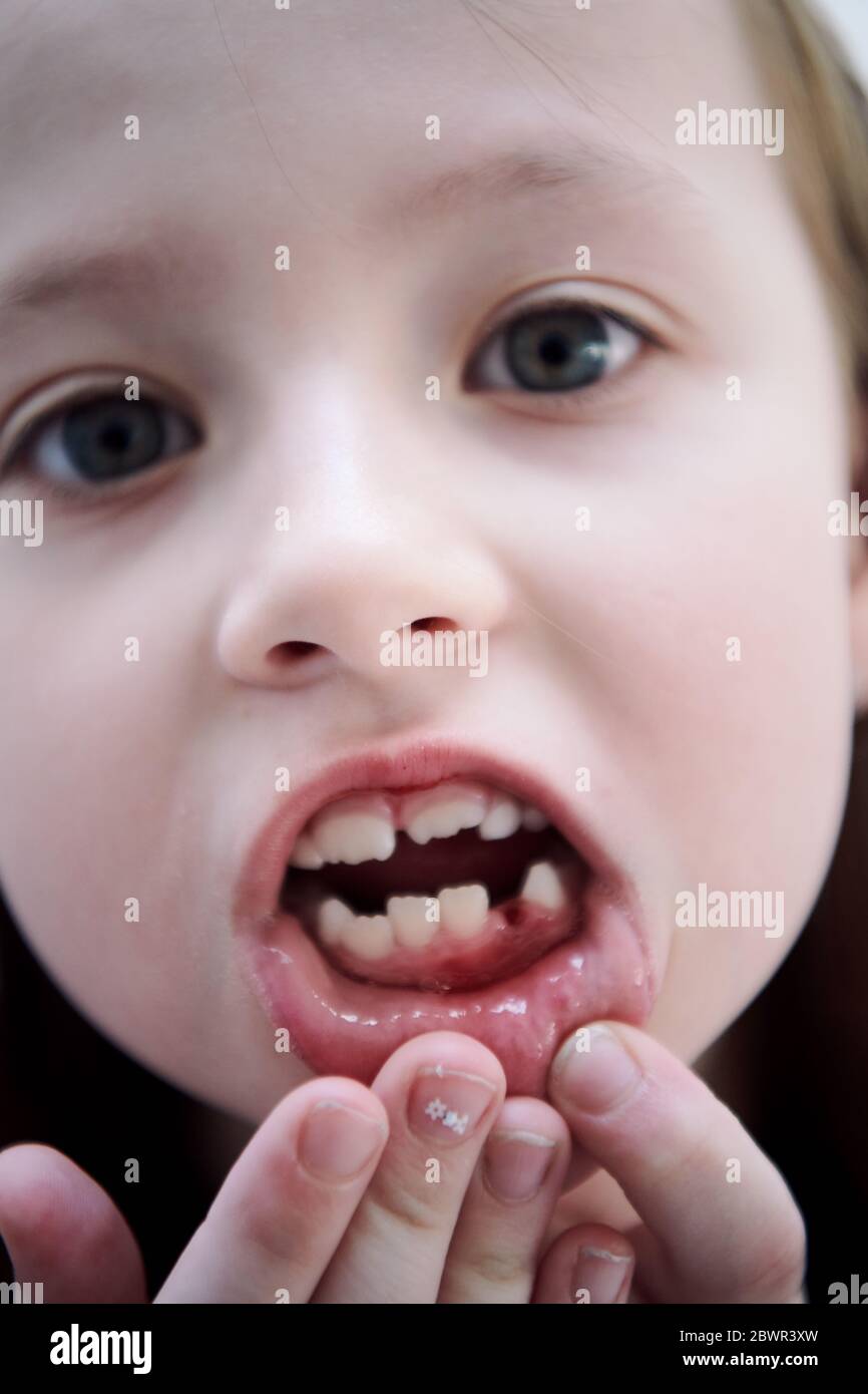 Funny little girl without tooth smiles showing gap close up Stock Photo ...