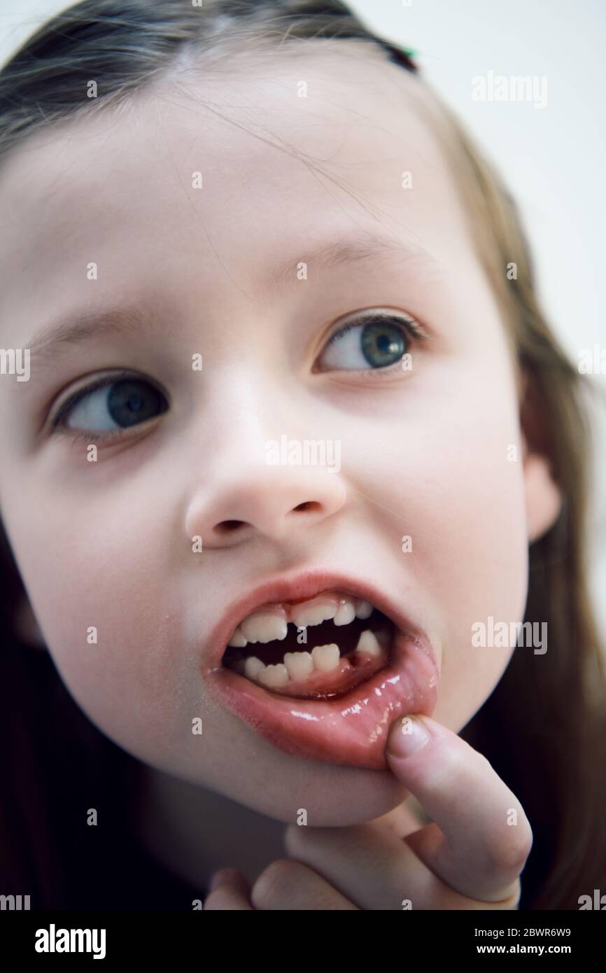 Funny little girl without tooth smiles showing gap close up Stock Photo ...