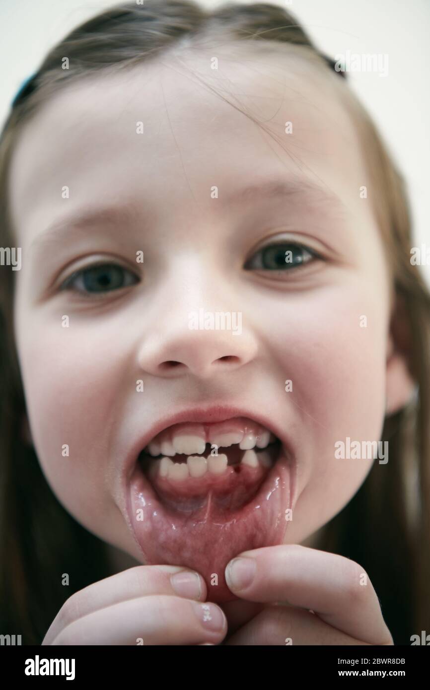 Funny little girl without tooth smiles showing gap close up Stock Photo ...