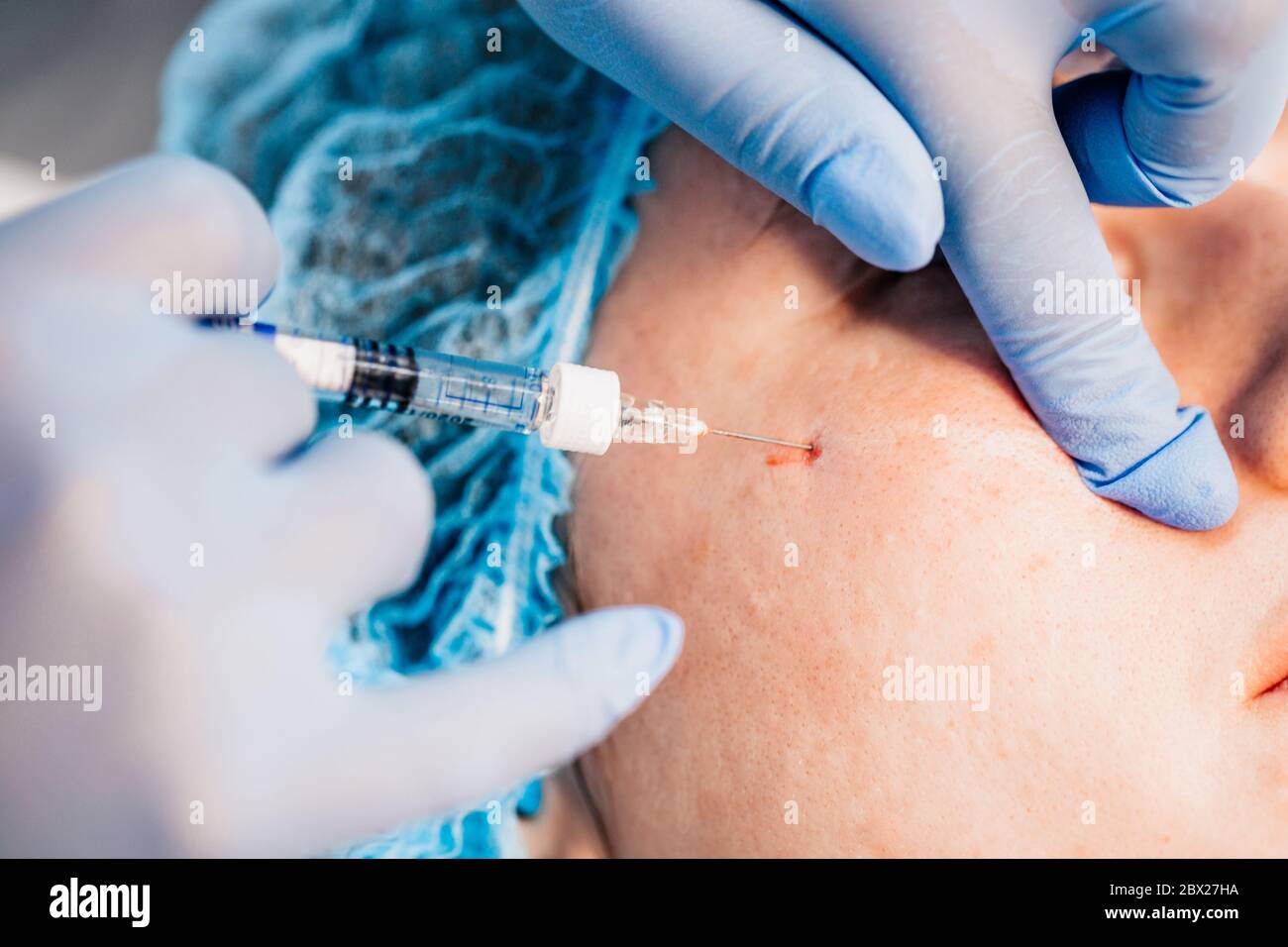 Contour correction is a procedure for filling wrinkles and restoring ...