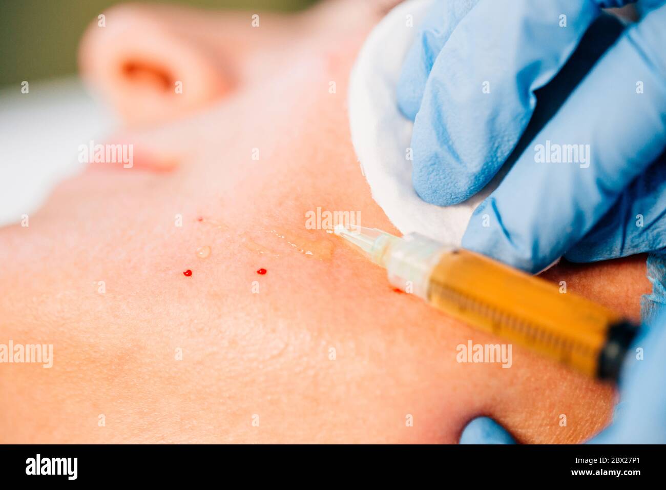 Plasma lifting - close up of skin marks from blood plasma injection ...