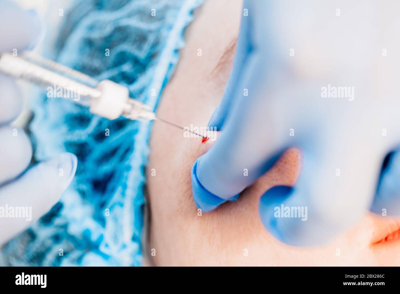 The procedure for the introduction of the active substance - under the ...