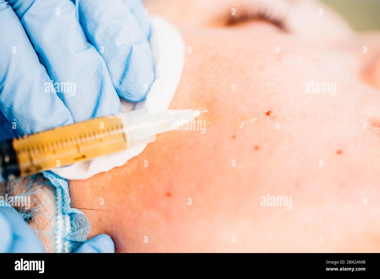 Plasma lifting - close-up doctor injects blood plasma under the patient ...
