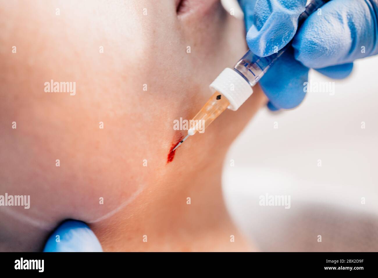 Non-surgical mandibloplasty - the corners of the mandible - Injection ...