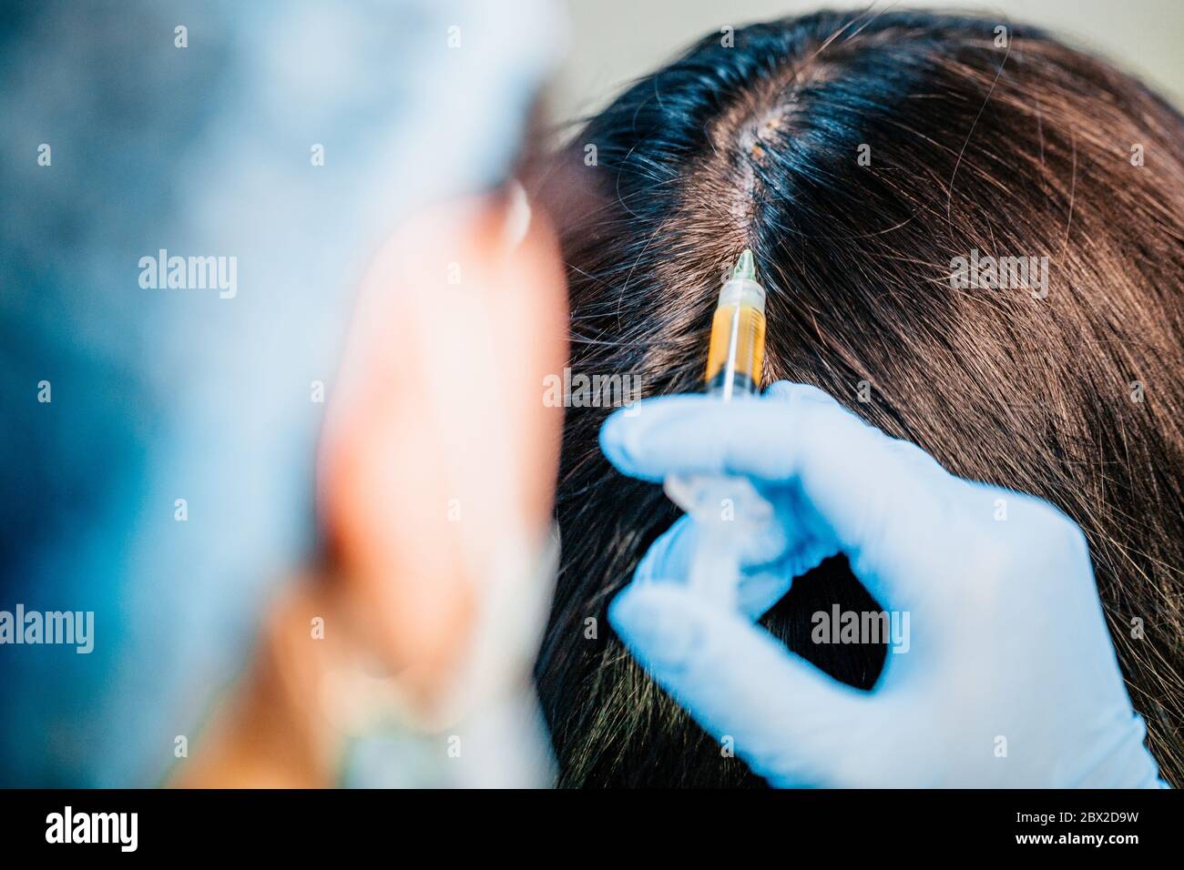 Medical cosmetic procedure for the preservation of hair - plasma ...