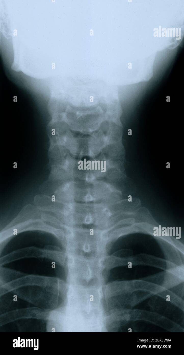 Xray of neck hi-res stock photography and images - Alamy