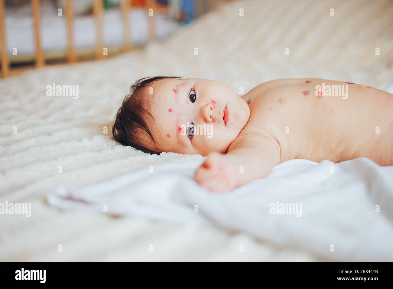 Baby With Chickenpox High Resolution Stock Photography and Images - Alamy