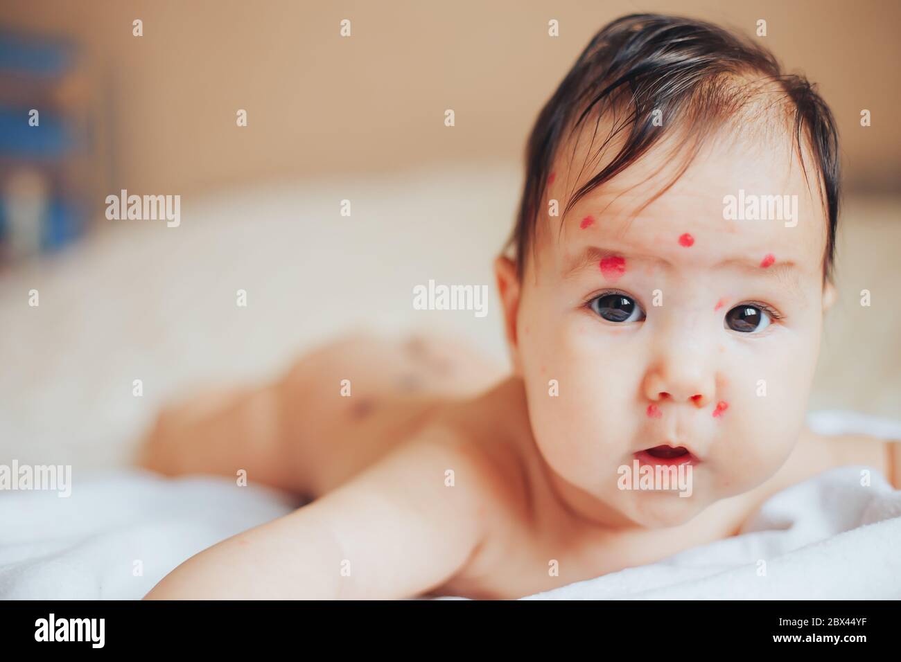 Mother holding little boy with red pimples at home. Chicken pox concept ...