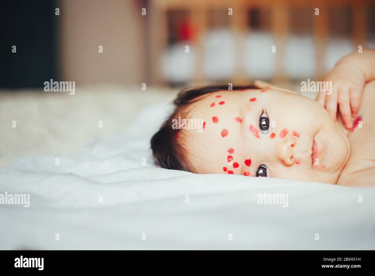 Smallpox Scab High Resolution Stock Photography and Images - Alamy