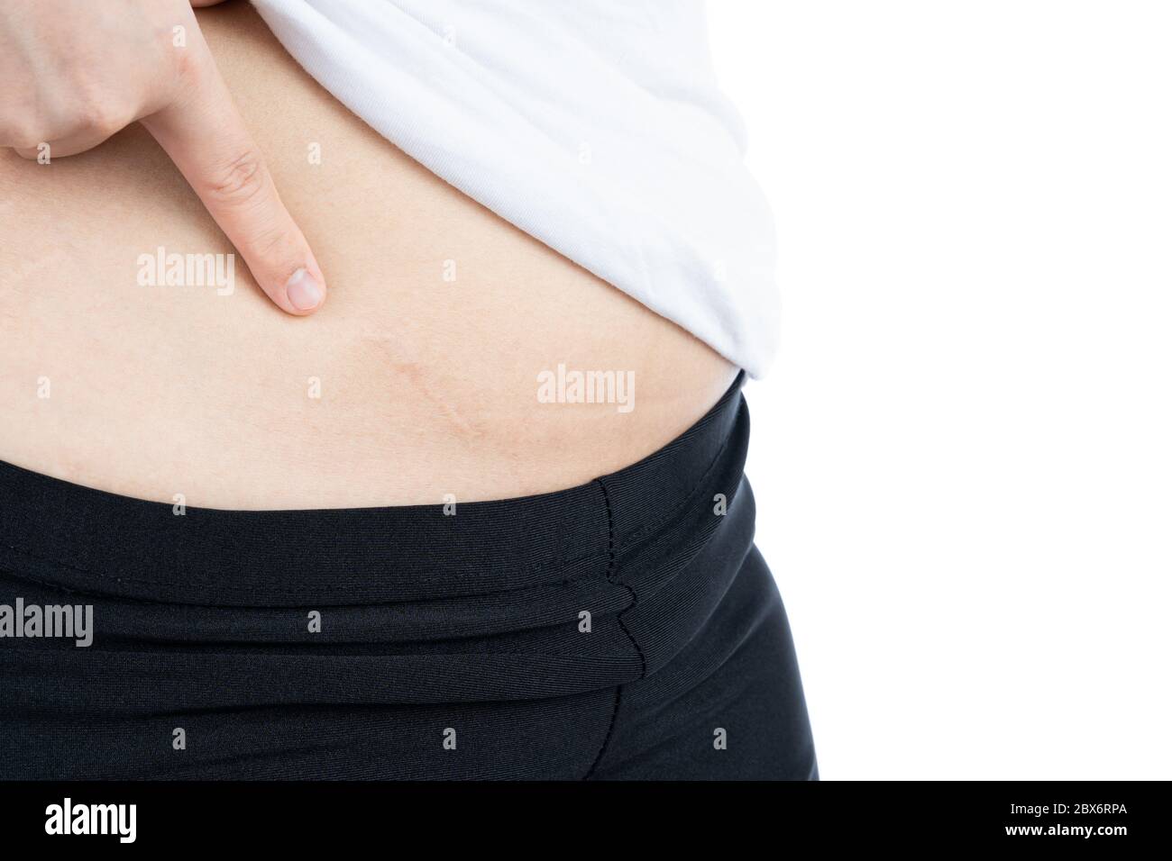 Appendix Scar Removal Before And After