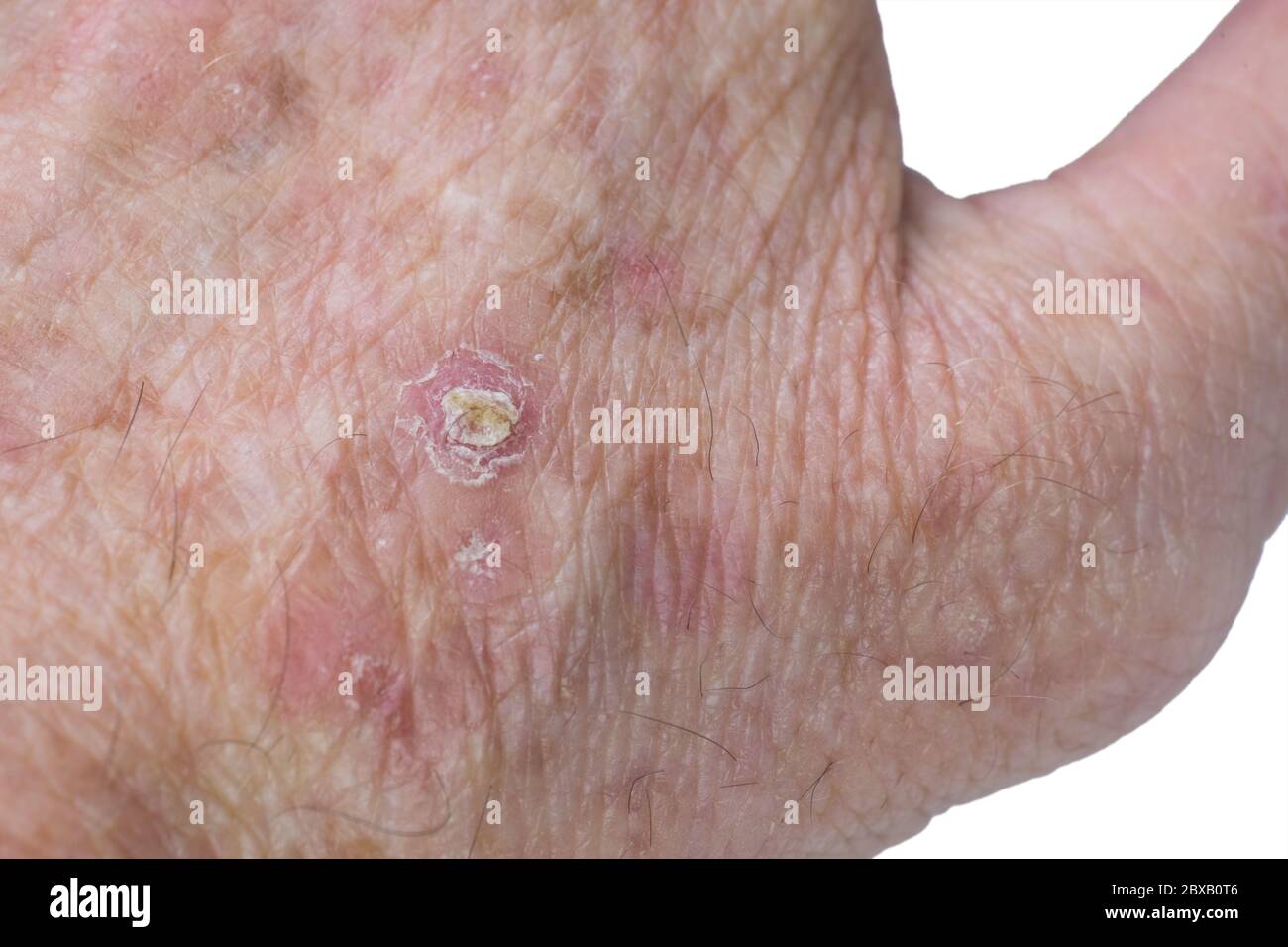 Skin healing of a pimple on the hand of a human cuased by scratching ...