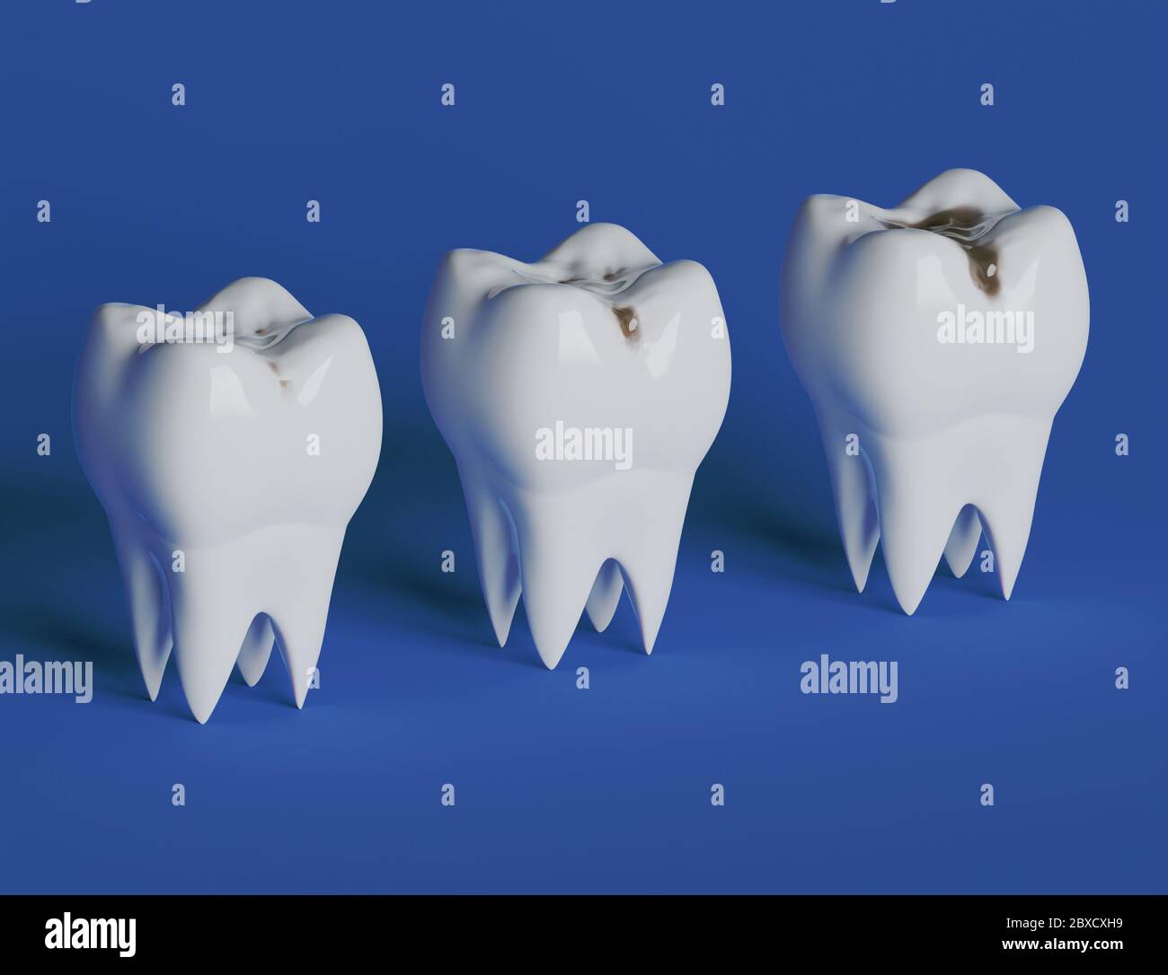 Three stages of tooth decay, caries. 3d illustration Stock Photo - Alamy