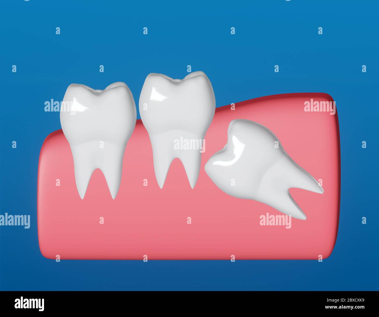 Wisdom tooth grows wrong, wisdom tooth problem, horizontal position of ...