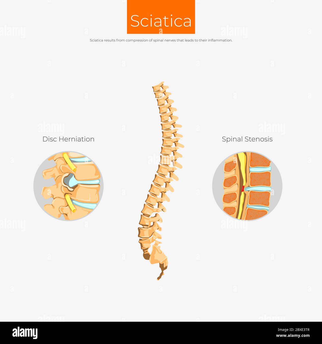 Sciatica results from compression of spinal nerves Stock Vector Image ...