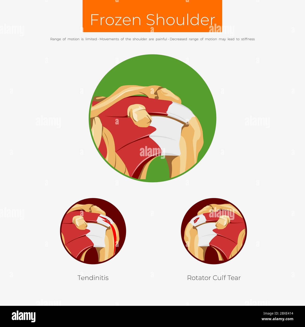 Frozen shoulder anatomy scheme poster Stock Vector Image & Art - Alamy