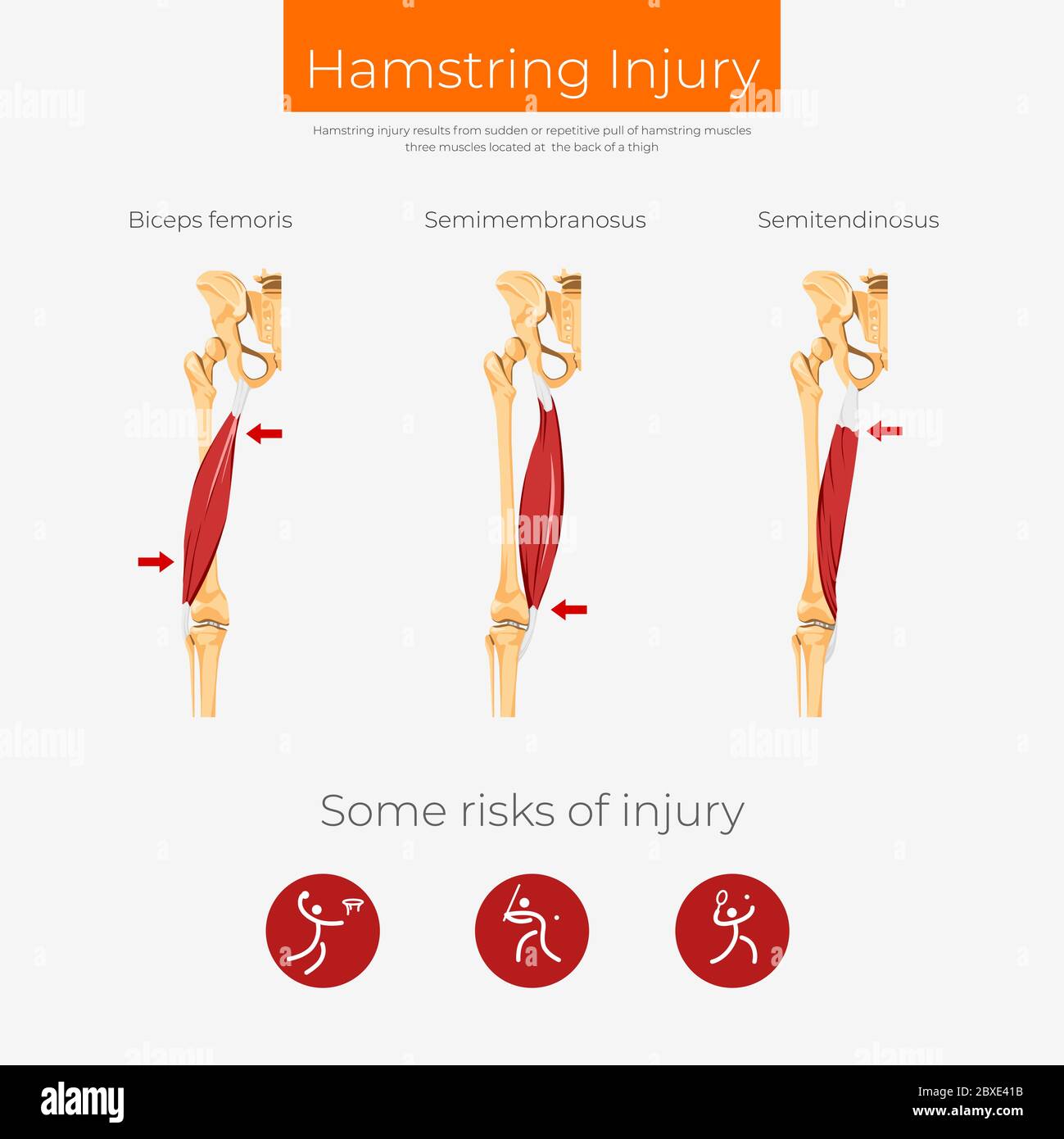 Hamstring injury anatomy scheme poster Stock Vector Image & Art - Alamy