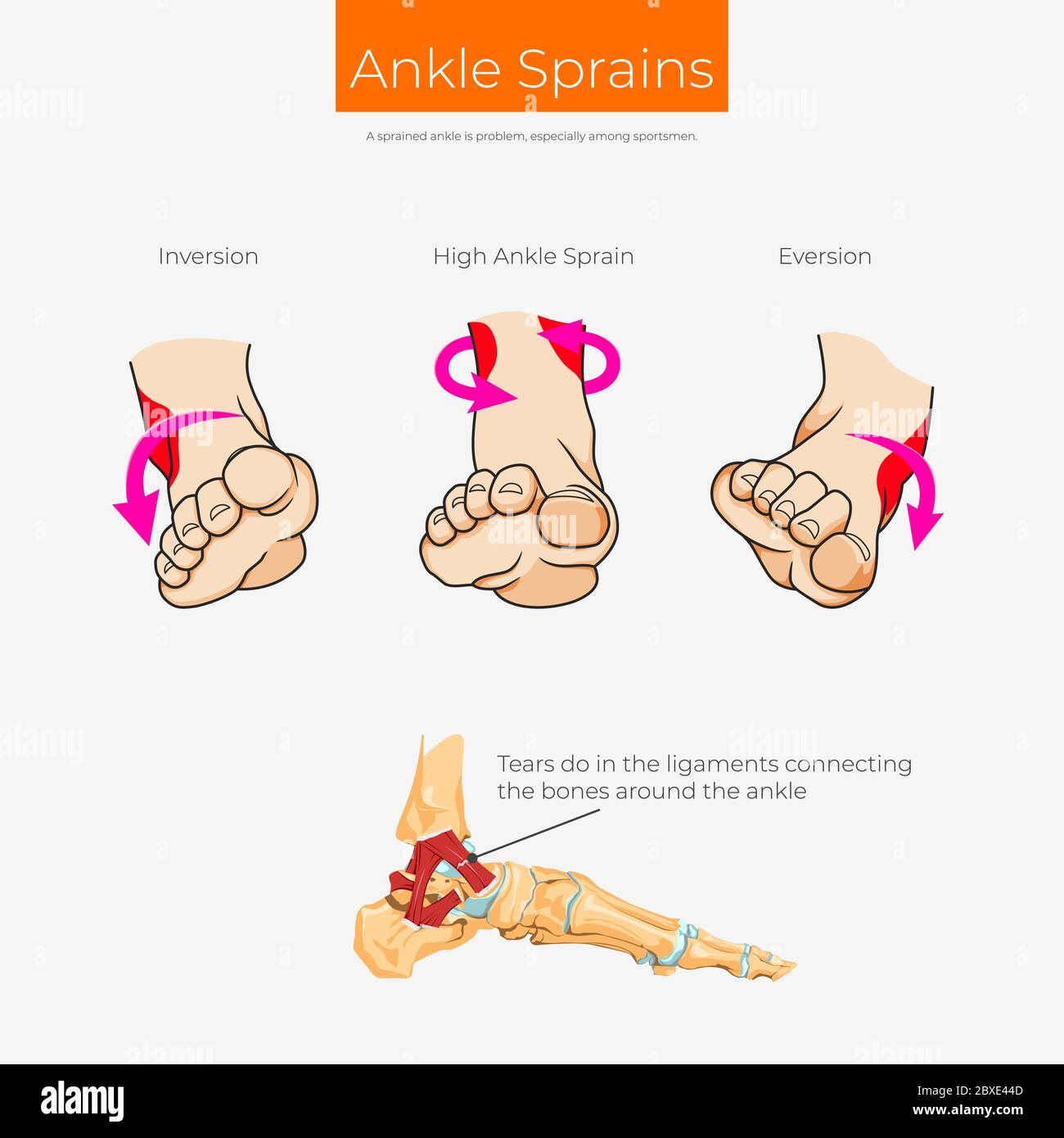 Types of ankle sprain scheme poster Stock Vector Image & Art - Alamy