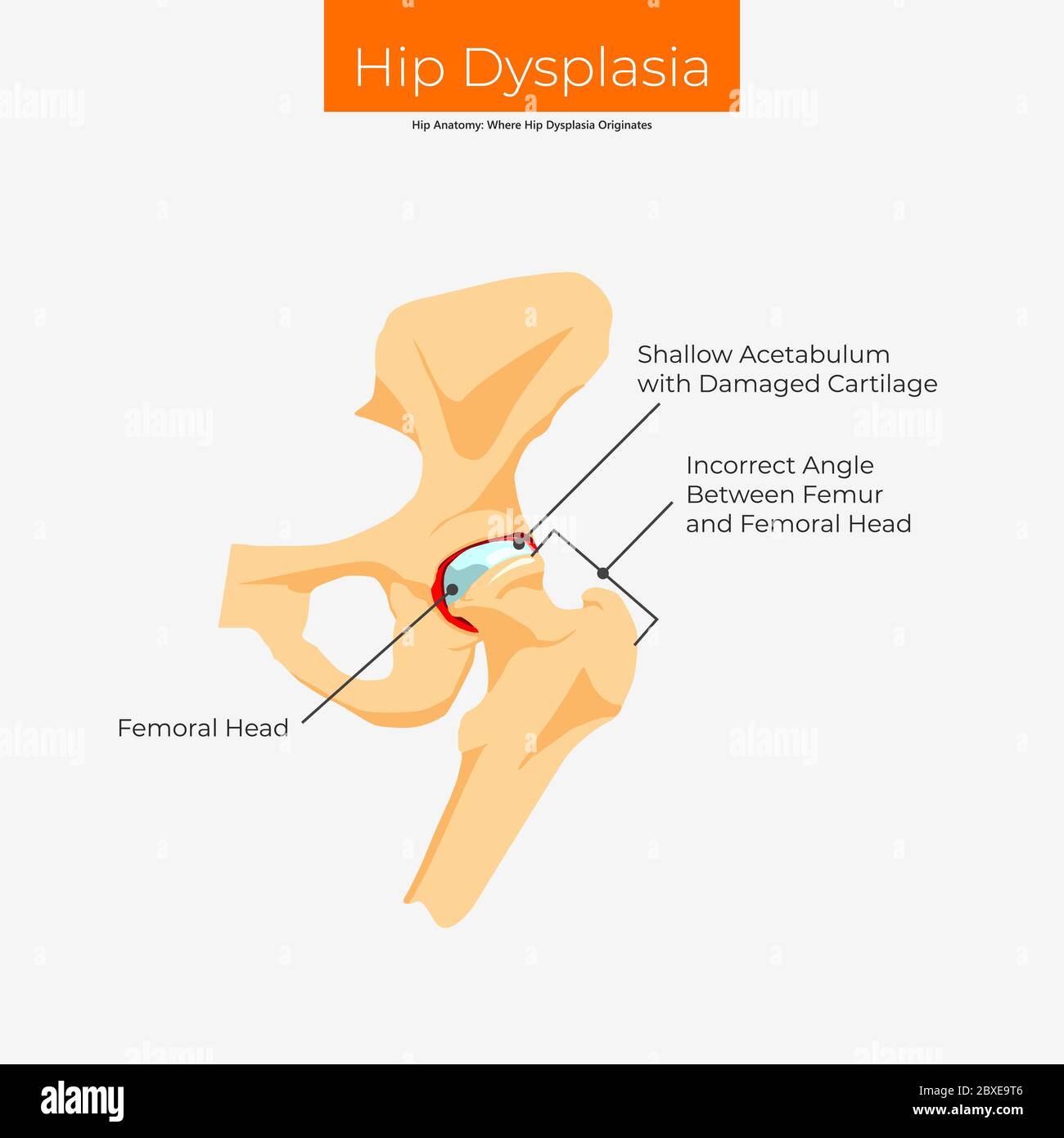 Hip dysplasia Stock Vector Images - Alamy