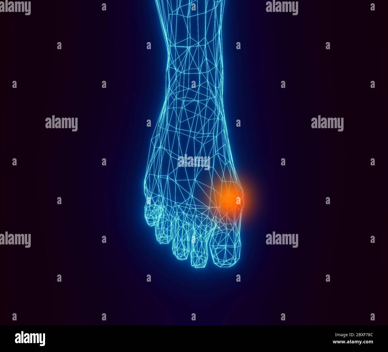 Club foot anatomy hi-res stock photography and images - Alamy