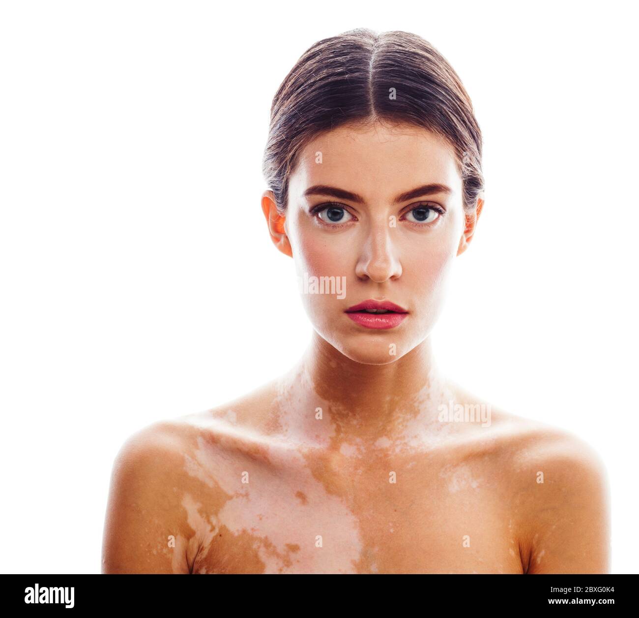 beautiful young brunette woman with vitiligo disease isolated on white ...