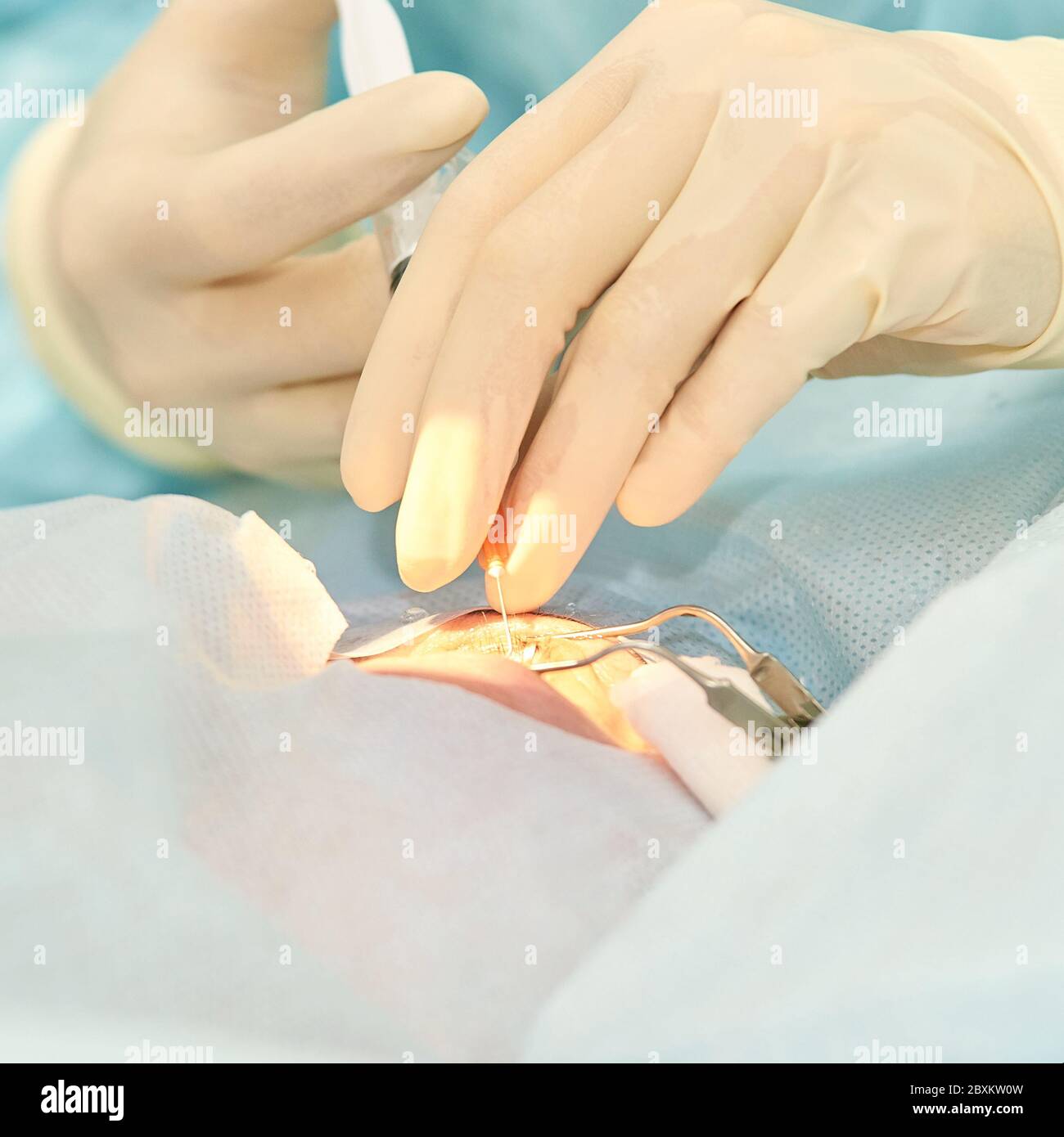 Ophthalmology laser microscope operation. Doctor in clinic. Patient eye ...