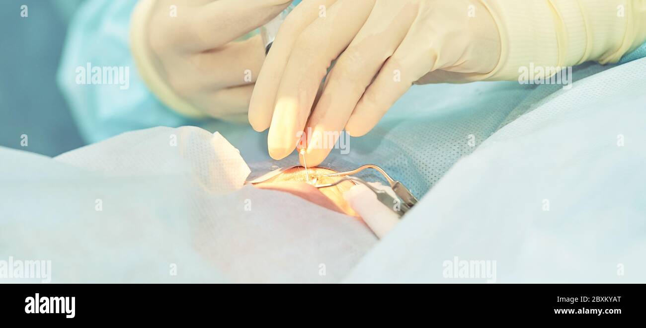 Ophthalmology laser microscope operation. Doctor in clinic. Patient eye ...