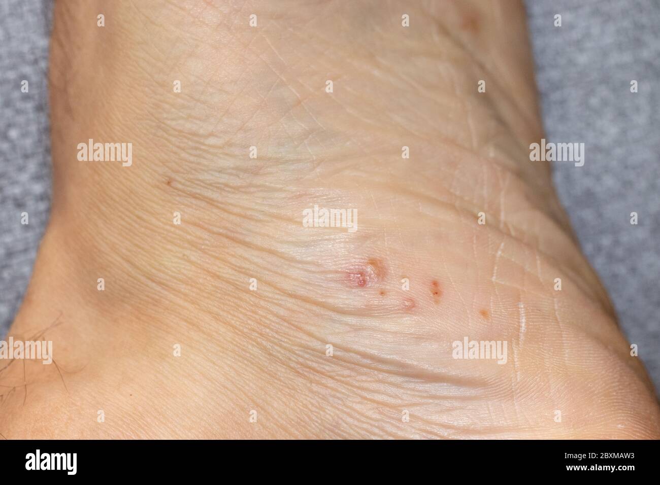 Close-up shot of a plantar wart on the bottom of a foot heel caused by ...