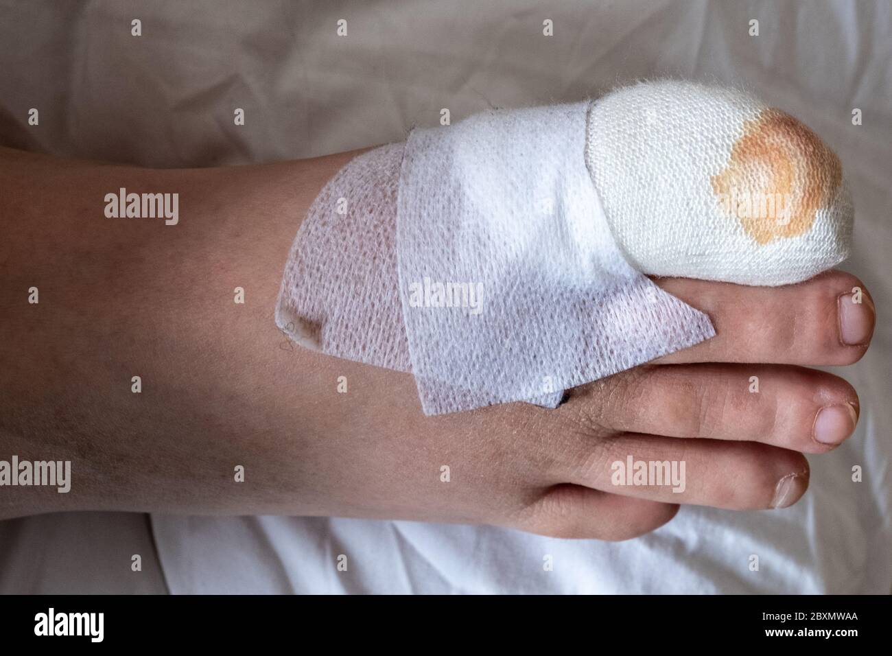 Laura has had one toenail removed and one cut back after three ...