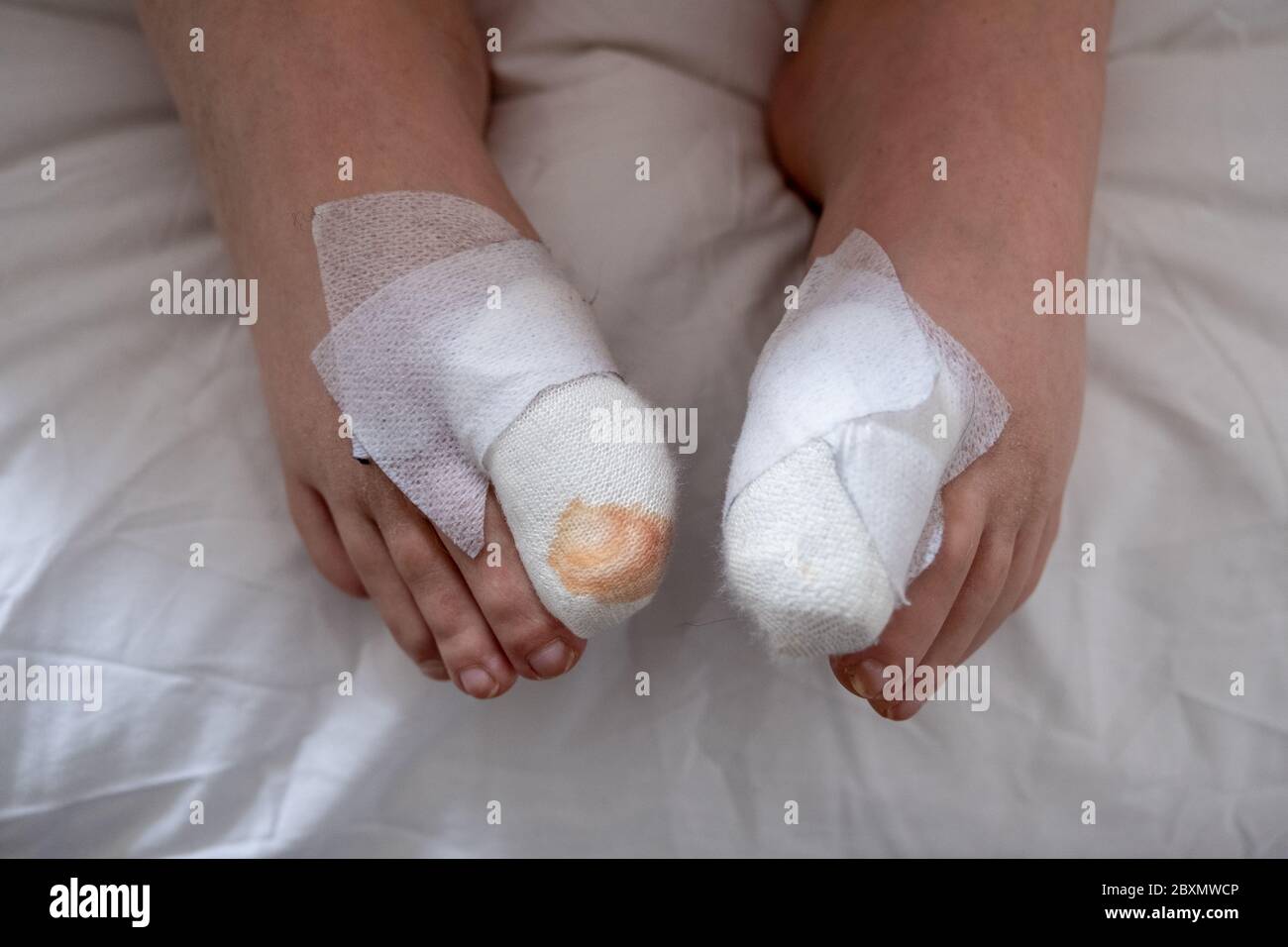 Laura has had one toenail removed and one cut back after three ...