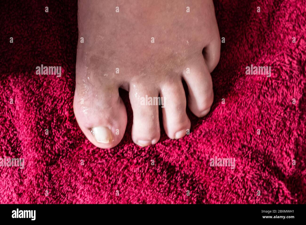 Laura has had one toenail removed and one cut back after three ...