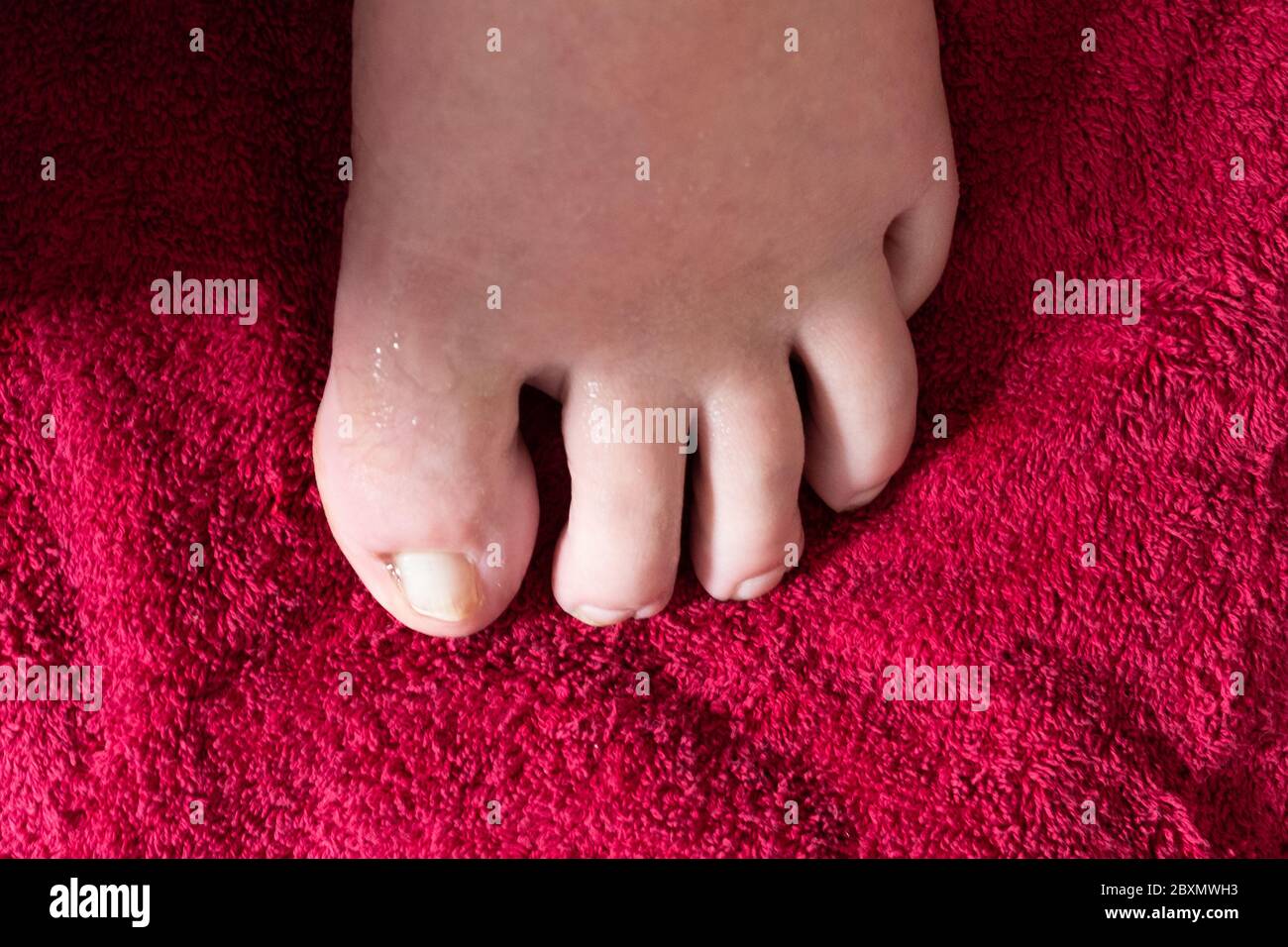 Laura has had one toenail removed and one cut back after three ...