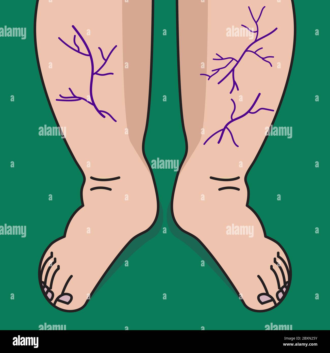 Varicose veins on legs of woman. Veins and vessels on shins Stock ...