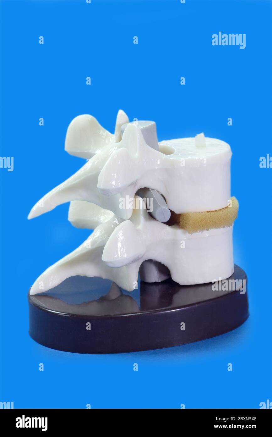 Spine disk hi-res stock photography and images - Alamy