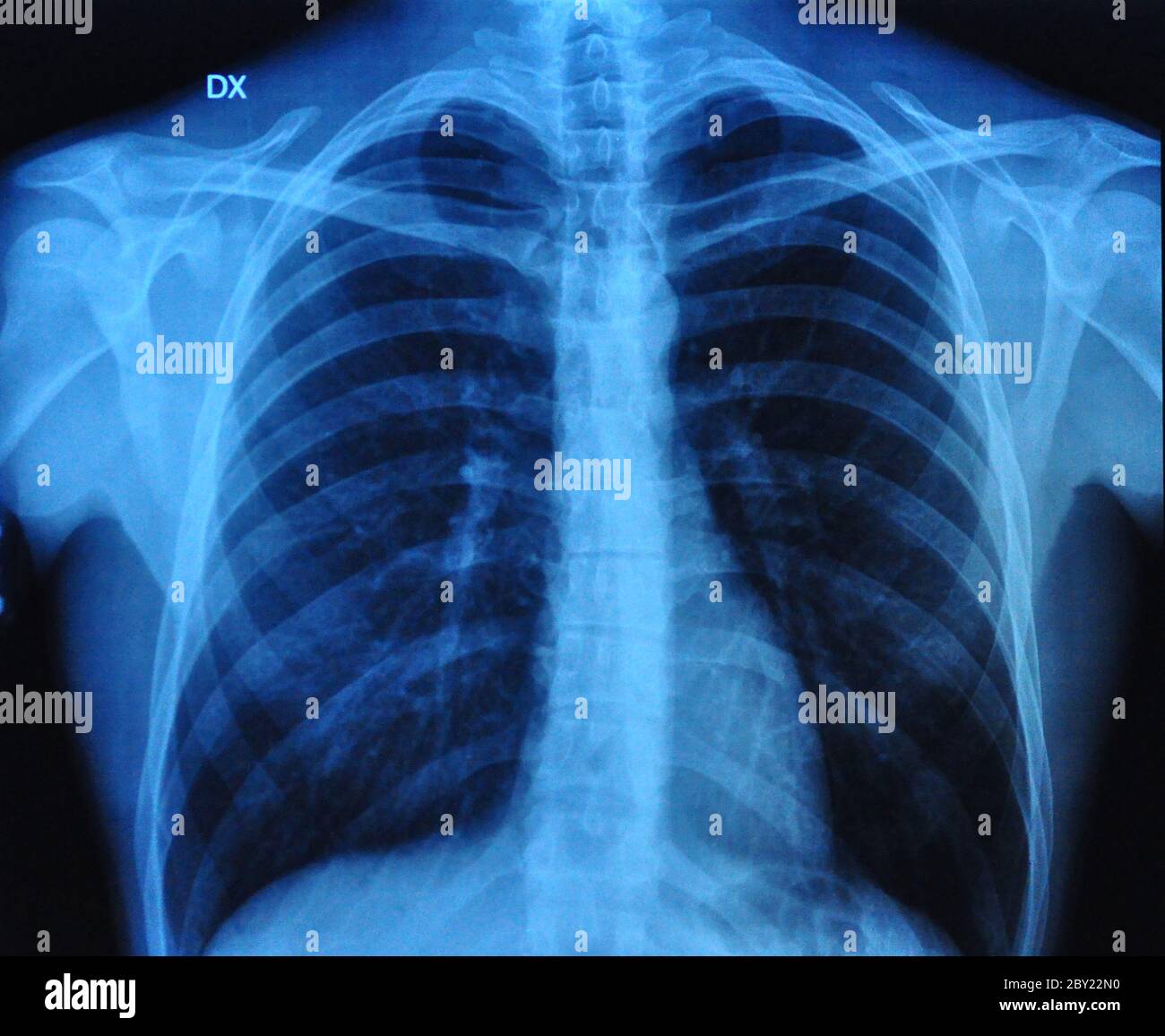 Chest x ray bronchitis hi-res stock photography and images - Alamy